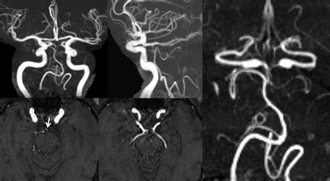 Posterior Cerebral Artery Neuroangio Org