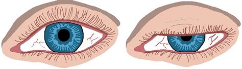 Myasthenia Gravis And The Eye