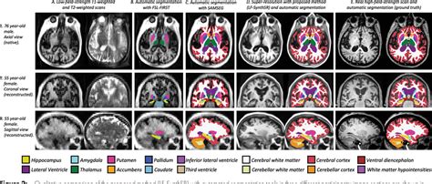 Figure 2 From Quantitative Brain Morphometry Of Portable Low Field