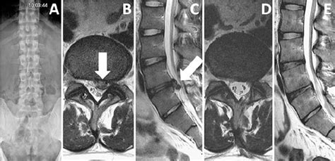 Microdiscectomy L5 S1