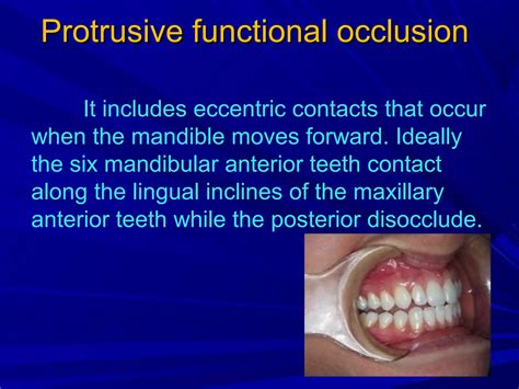 Concepts Of Dental Occlusion And Importance Of Six Keys Of Occlusion In