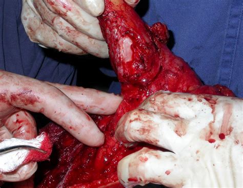 Ewing Sarcoma Of The Tibia Oncosurgery