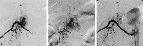 Figure 2 From Preoperative Transarterial Embolization Of Spinal Tumor Embolization Techniques