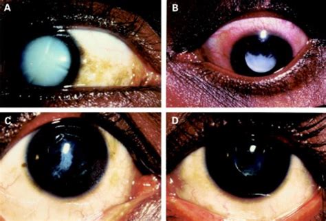 Moran Core Spontaneous Cataract Absorption