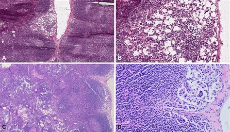 Axillary Sentinel Lymph Node Assessed Via Telepathology From Patient 10