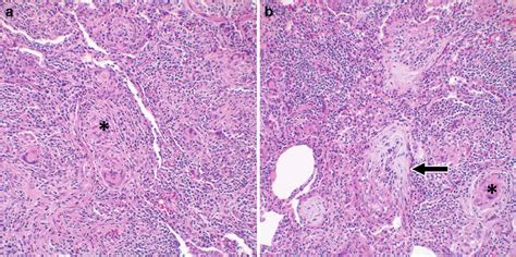 Interstitial Lung Disease Histology Interstitial Lung Diseases