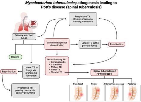 Pathogenesis And Clinical Presentation Of Potts Disease Encyclopedia Mdpi