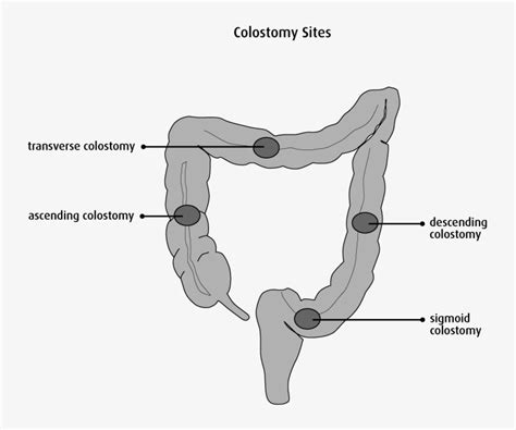 Image Free Colostomy And Ileostomy Canadian Society Transverse End Colostomy 731x604 Png