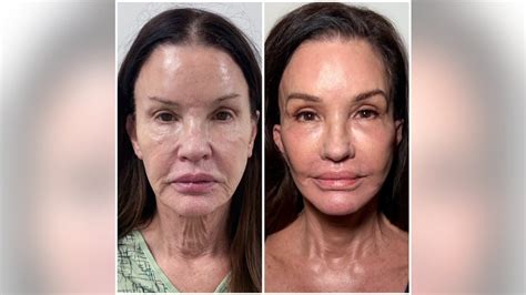 Supermodel Janice Dickinson Unveils Major Facelift Transformation At 71