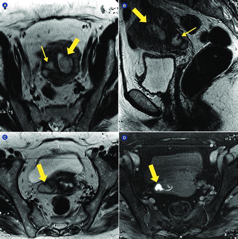 Pelvic Mri A Axial T2 Wi Shows A Polypoid Lesion In The Uterine