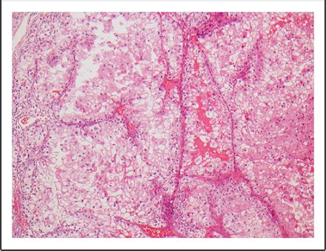 Figure 1 From Nodular Vascular Transformation Of The Lymph Node Sinuses