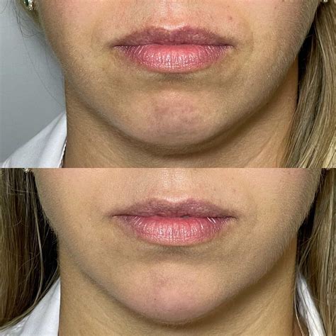 What Are The Risks Of Treating A Dimpled Chin With Botox