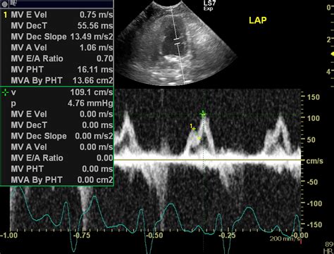 Diastolic Dysfunction And Heart Rate Members