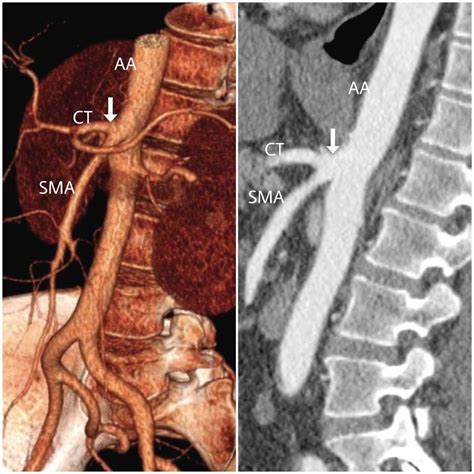 Abdominal Aorta Celiac Trunk