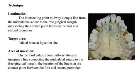 Maxillary Nerve Block Pptx
