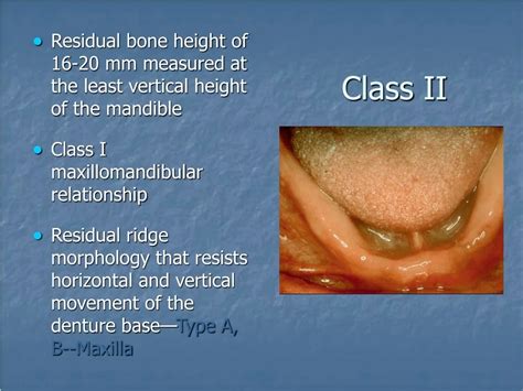 Ppt Complete And Partial Edentulism Powerpoint Presentation Free Download Id9310679