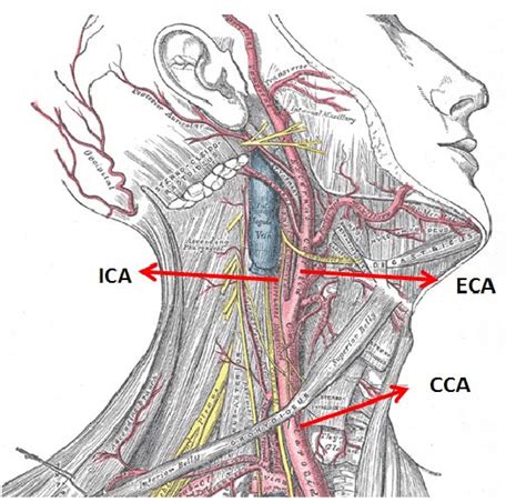 The Right Carotid Bifurcation With Cca Eca And Ica From 81 Without