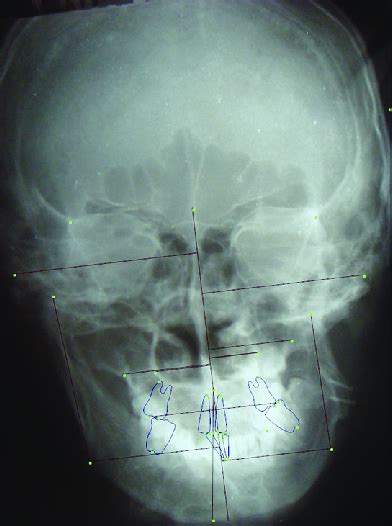 Pretreatment Posteroanterior Cephalogram Download Scientific Diagram