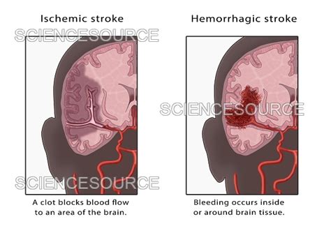 Ischemic And Hemorrhagic Stroke Illustr Stock Image Science Source