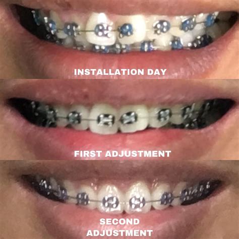 Result In 3 Months Butterfly Incisors Of My Two Front Teeth Rbraces