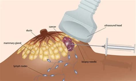Breast Cancer Understanding Diagnosis And Treatment