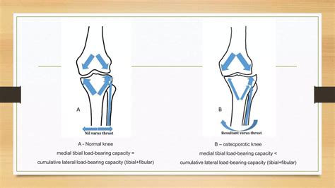 Proximal Fibular Osteotomy For Knee Osteoarthritis What Is The