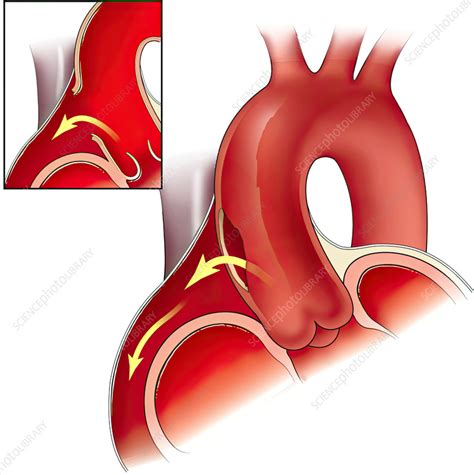 Aortic Rupture Illustration Stock Image C0593331 Science Photo