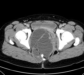 Sacrococcygeal Teratoma In Adults