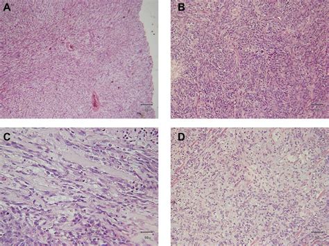 A Stromal Hypercellularity Of The Lesion The Proliferating Spindle