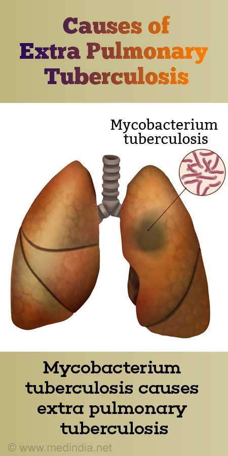 Extrapulmonary Tuberculosis Symptoms