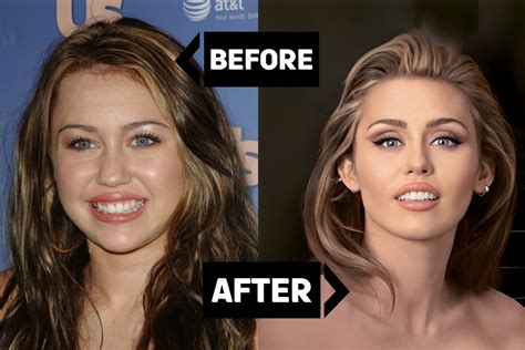 The Evolution Of Miley Cyrus Aesthetic Smile Antalya Dent Smile