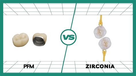 Pfm Vs Zirconia Crown Comparative Guide For Dentists