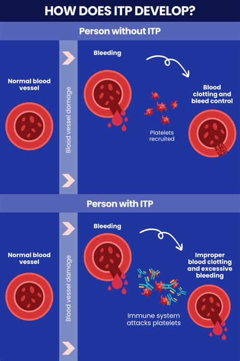 Immune Thrombocytopenia Everything You Need To Know Bleeding