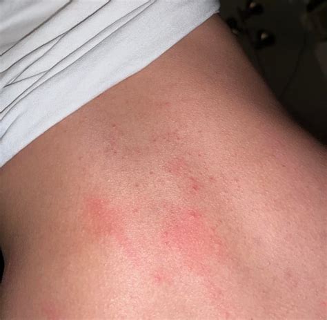 Help Back Rash Rdiagnoseme