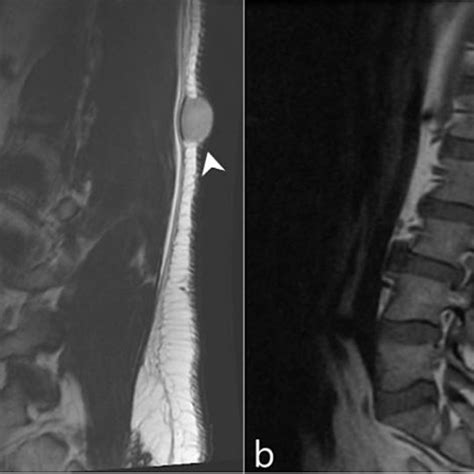 A Sagittal T2 Weighted Mri Illustrates The Dermatofibrosarcoma