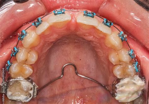 Dental Orthodontics Braces With Blue Colored Elastic Ligatures Niti Palatal Expander Metallic