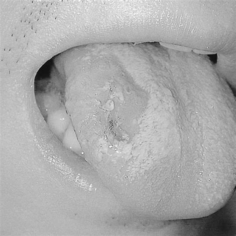 Multiple Lingual Ulcerations A And A Small Penile Root Ulcer With