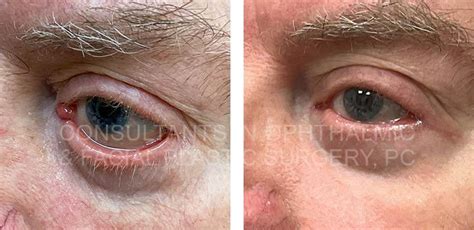 Repair Ectropion Both Lower Lids Bilateral Excision Of Conjunctival