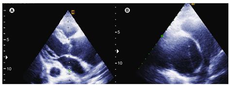 Transthoracic Echocardiography A Dilated Ascending Aorta In Download Scientific Diagram