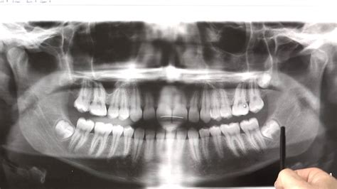 Look How Do Impacted Wisdom Teeth