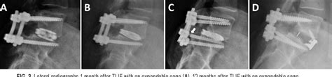 Figure 1 From Long Term Radiographic Outcomes Of Expandable Versus