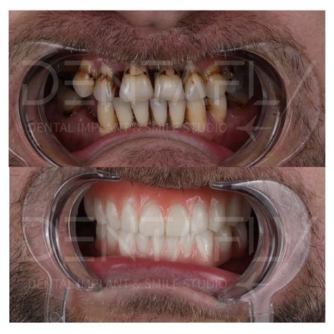 Before And After Teeth Photos 21 Cases
