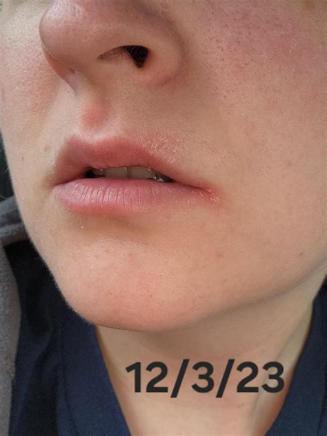Reoccuring Lip Patch Rdermatologyquestions