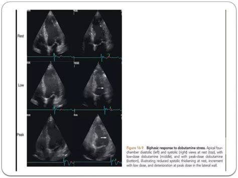 Myocardial Viability In Severe Lv Dysfunction Ppt