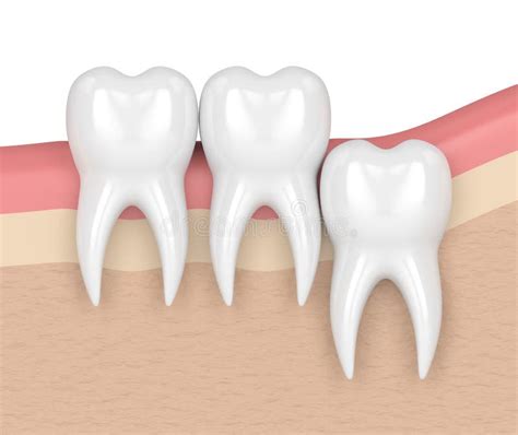 Wisdom Teeth Vertical Impaction Stock Vector Illustration Of Icons