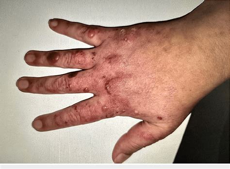 Figure 1 From Bullous Systemic Lupus Erythematosus A Case Report
