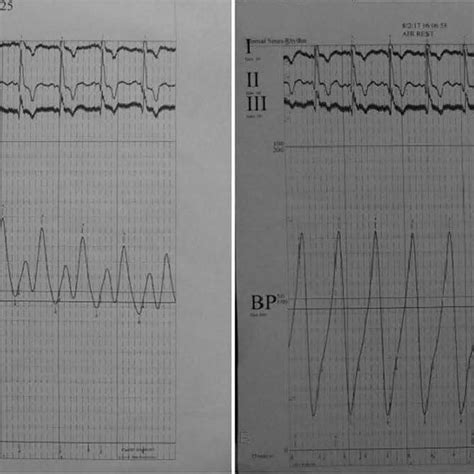 A Left Atrial Pressure Trace Before Procedure B Rise In Left Atrial