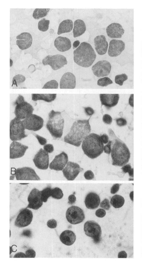 Fnac Of Malignant Lymphoma Lymph Node The Malignant Lymphoid Cells In