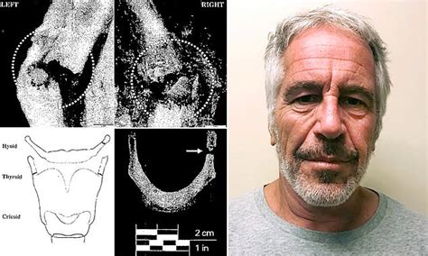 Photos From Jeffrey Epsteins Autopsy Showing Neck Fractures Are Shared