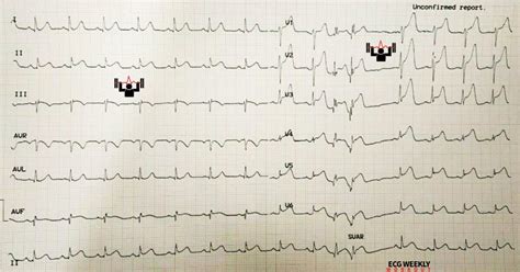Differential Diagnoses Diffuse St Segment Elevation Without Reciprocal